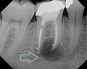 Why Does a Tooth Need to Be Extracted | Topeka Oral Surgery