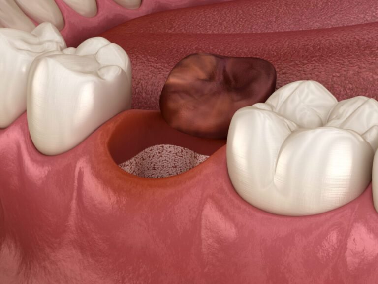 Top Tips to Avoid Dry Socket Post-Extraction | Topeka Oral Surgery