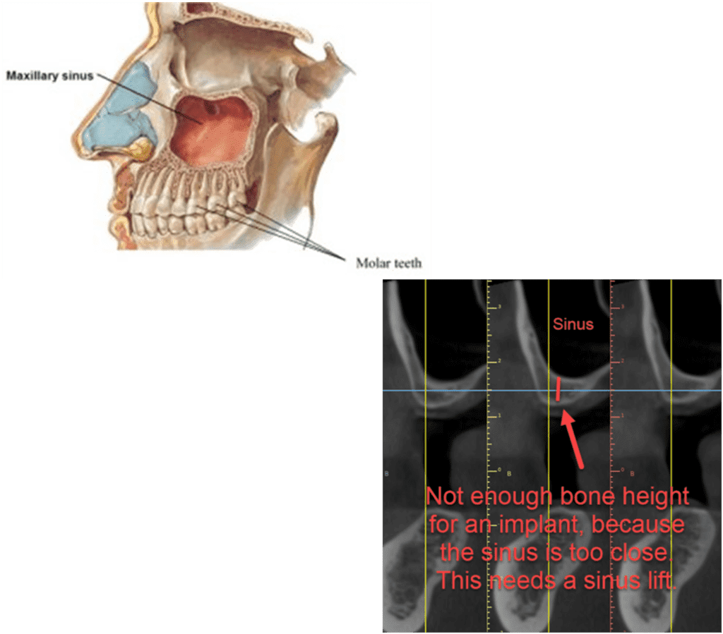 Bone Grafting Solutions by Topeka Oral Surgery | Call Now